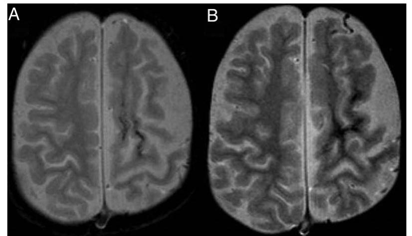 (a and b) mri axial t2-weighted fast-field echo sequence