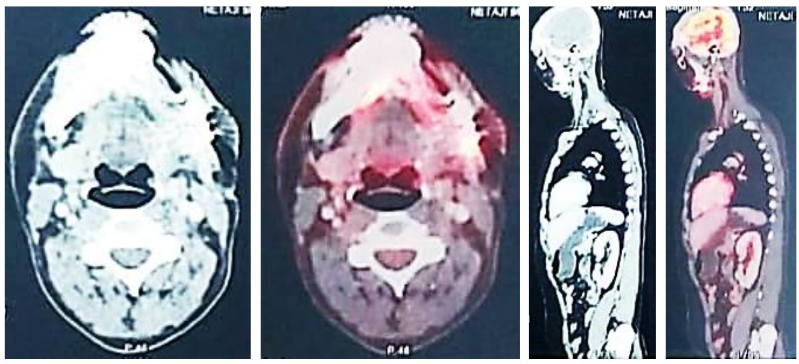 Post-operative pet-ct scan the lesional cells expressed