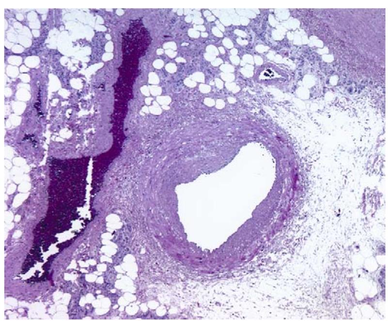 Histology of avms. conventional hematoxylin and eosin