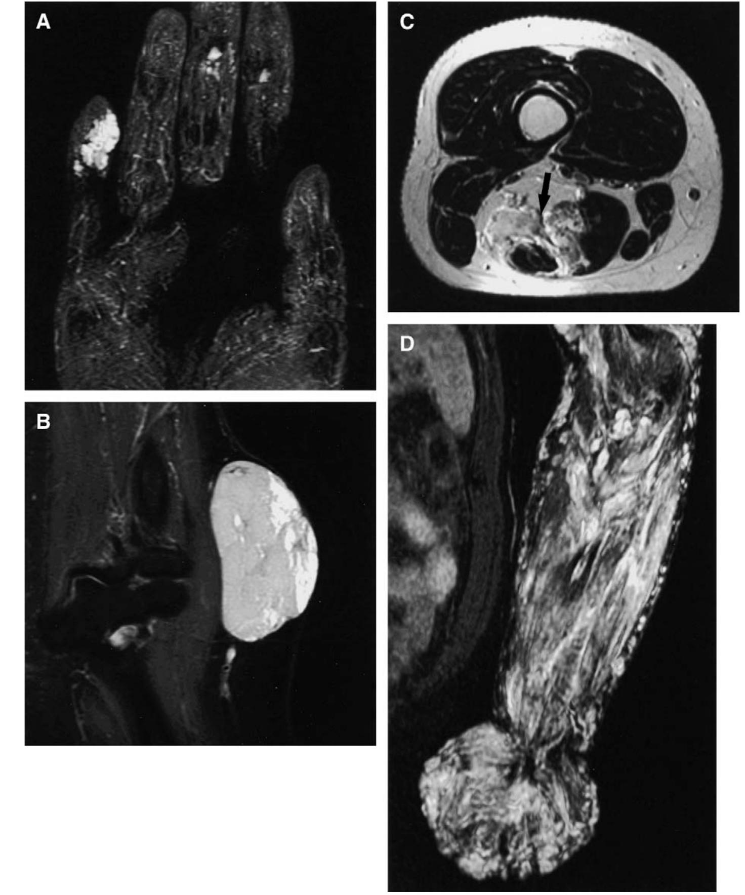 Mri grading classification of vms [59]. (a) grade i lesion