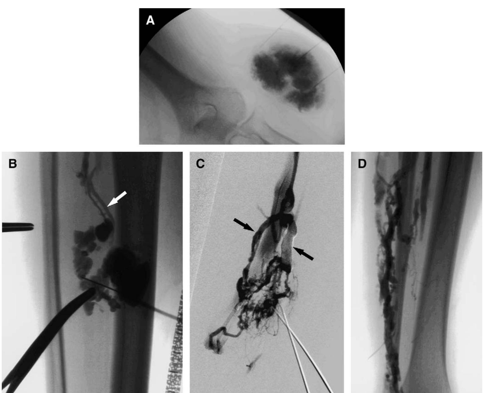 Vm types on phlebography. (a) phlebography shows type 1