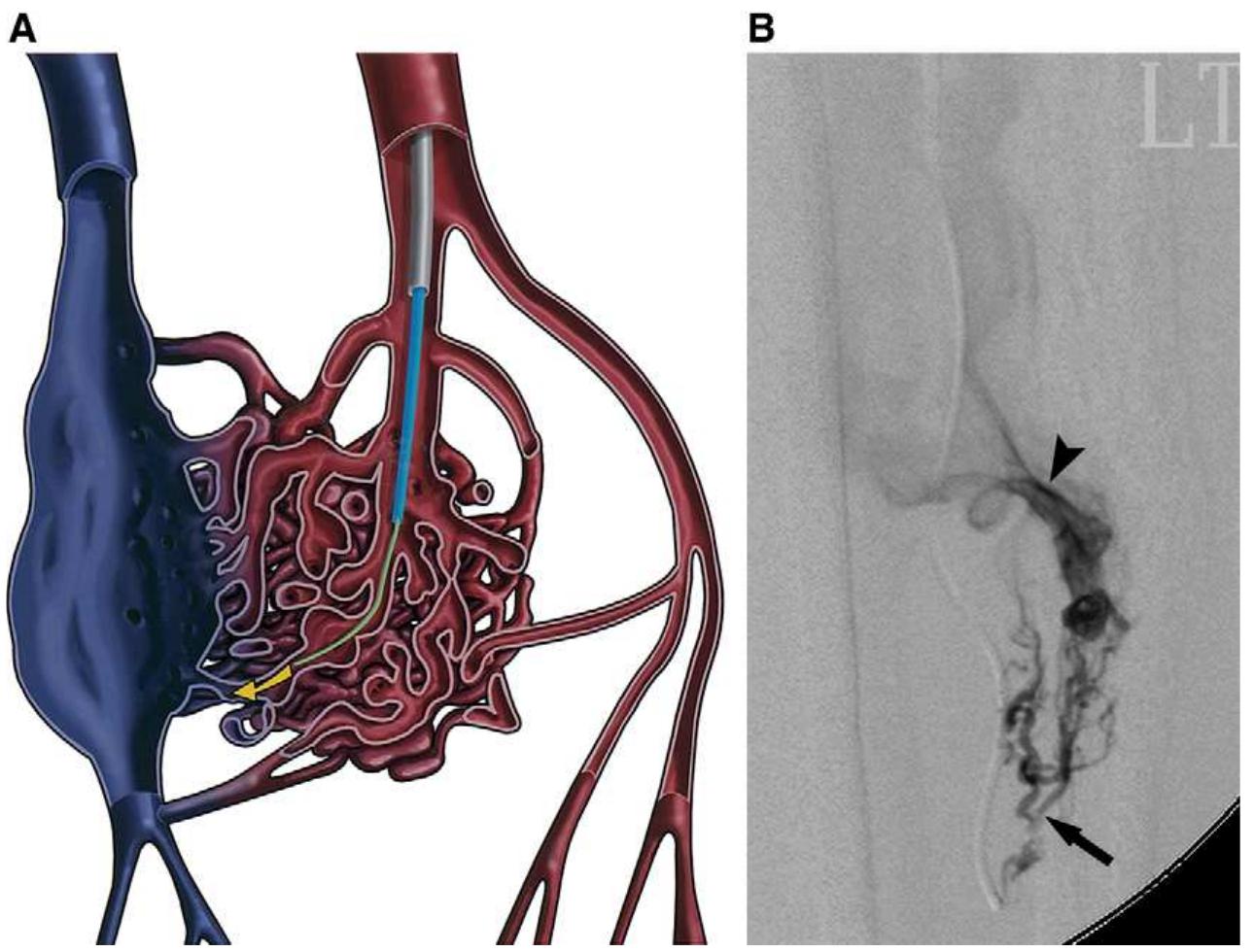 Transarterial routes to avm nidus. (a) a superselective