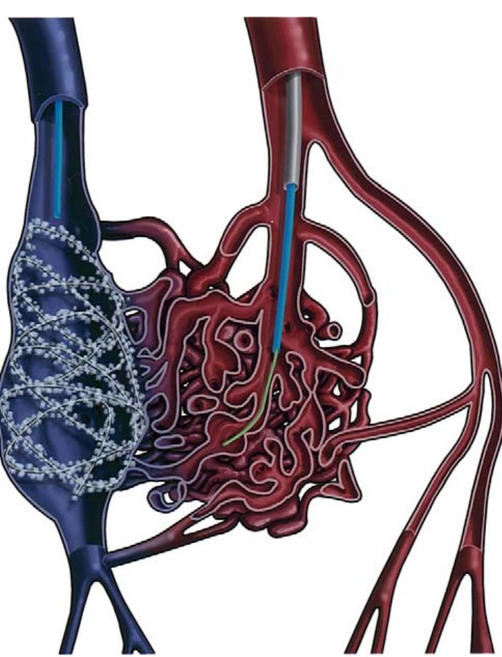 Permanent venous outflow occlusion. coil em- bolization of