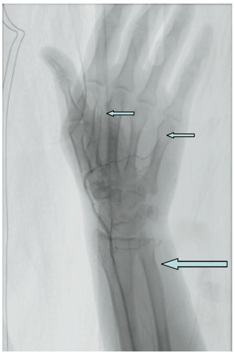 A left upper extremity angiogram demonstrates no flow