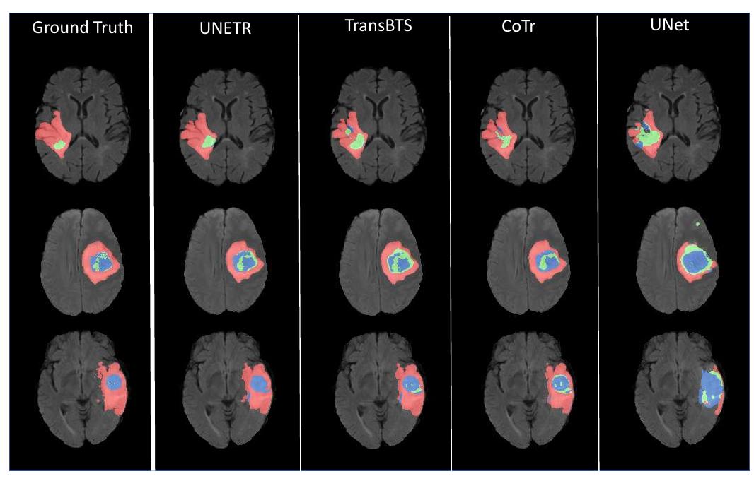 Comparison of visualization of brain tumor segmentation on