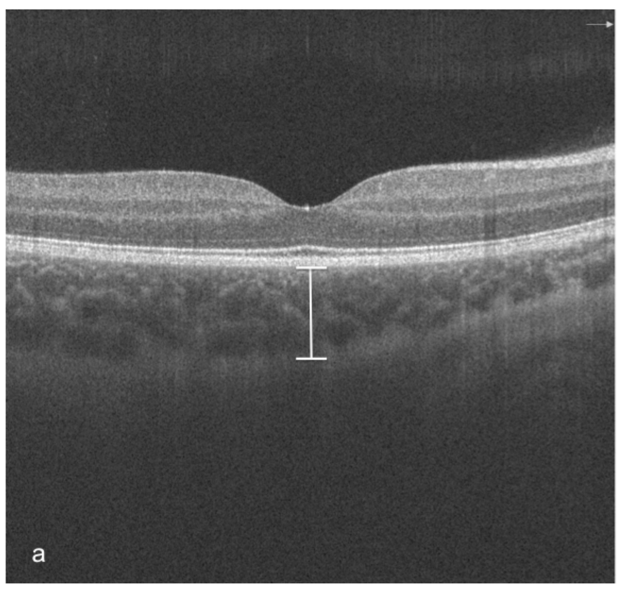 Figure 1 - Choroidal thickness and ocular growth in