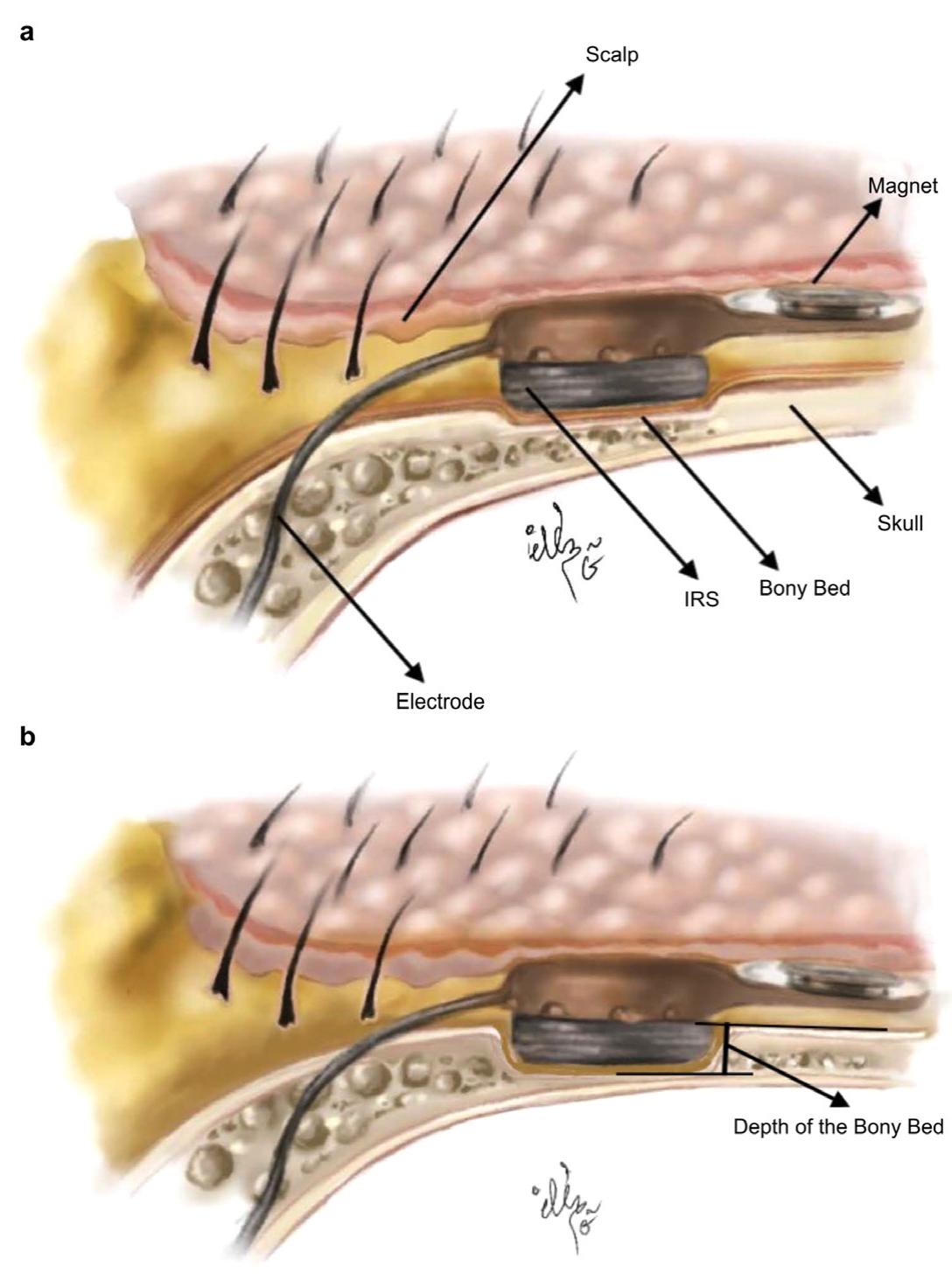 (1). cochlear implant device in a subperiosteal pocket,