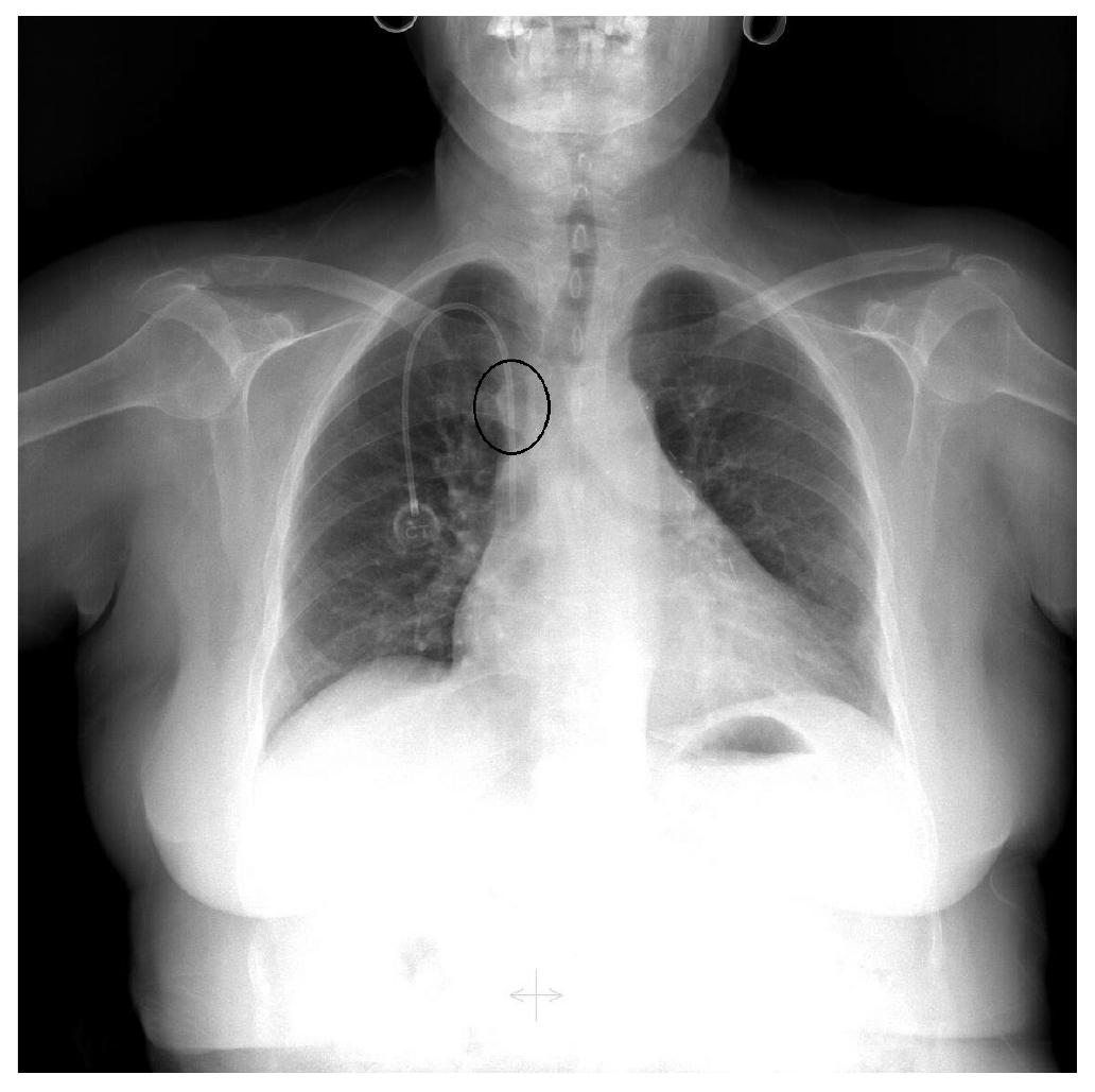 Figure 2 - A rib abnormality mimicking pulmonary nodule: a