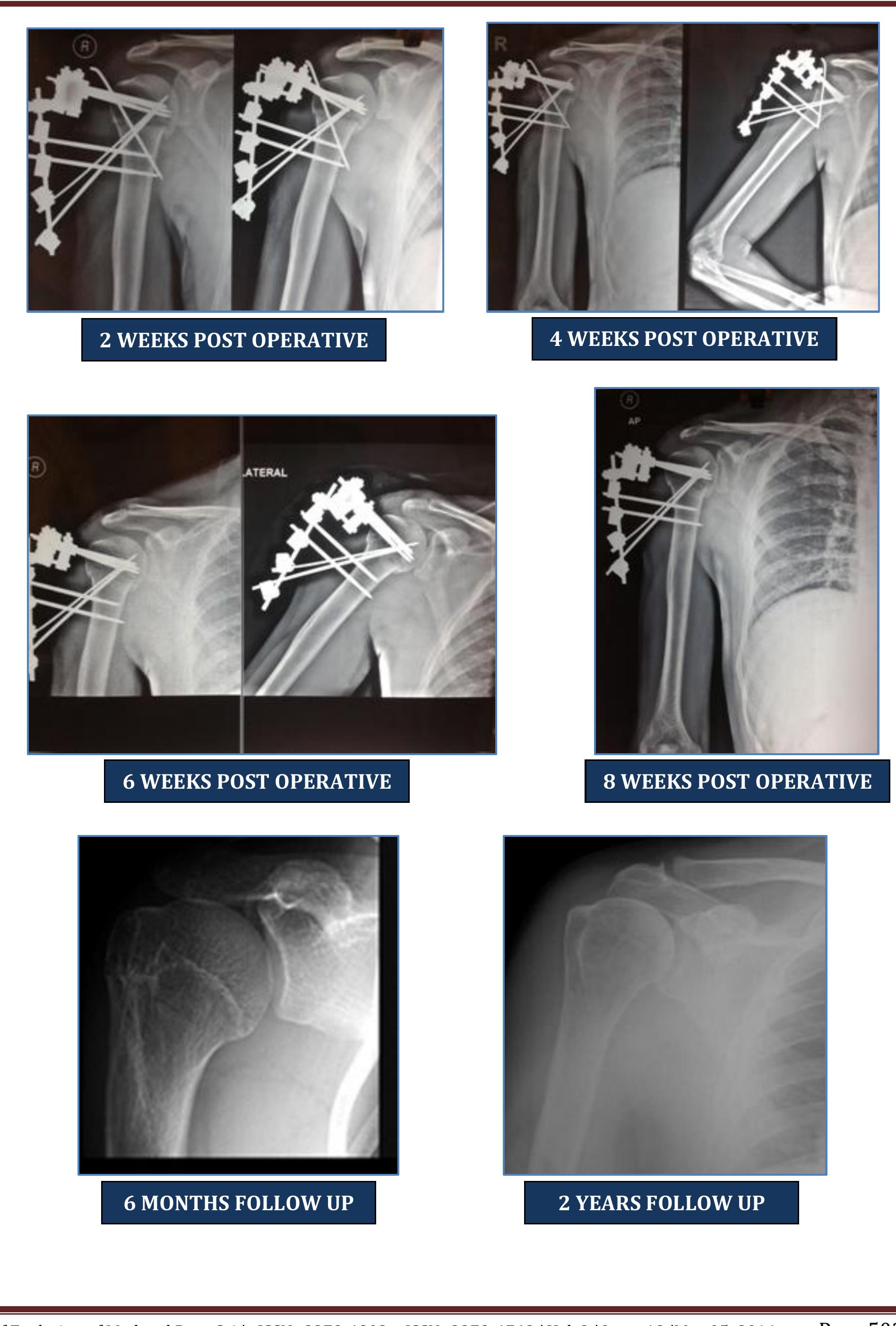 Figure 6 - Surgical Management of Proximal Humerus Fracture