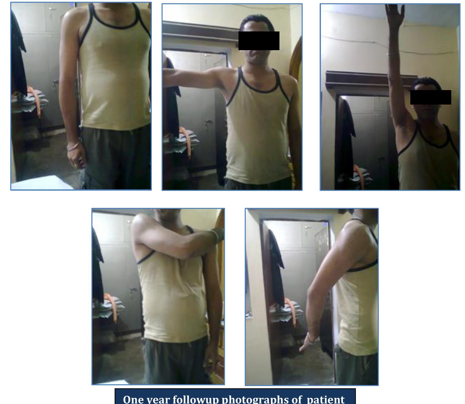 Disscusion: the closed proximal humeral fractures have been