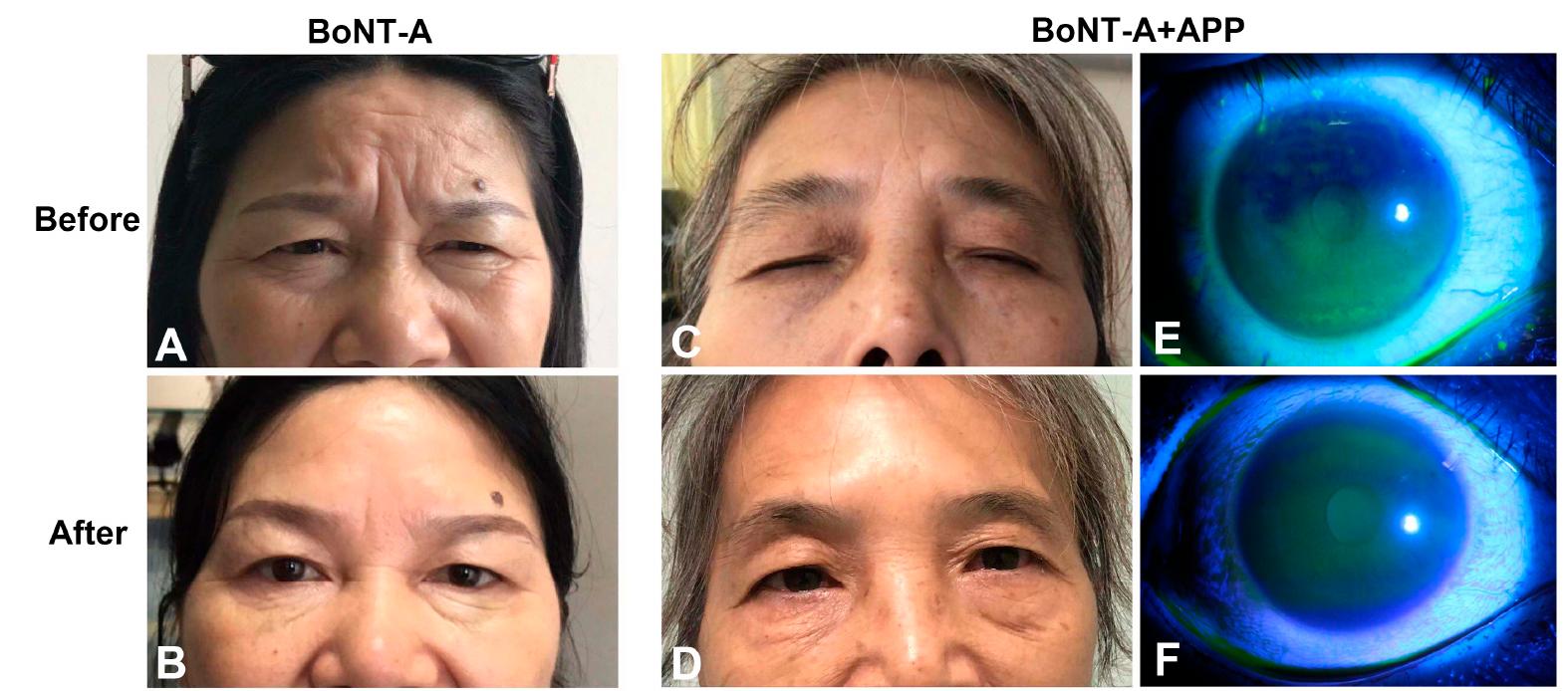 Typical manifestations of blepharospasm patients before and