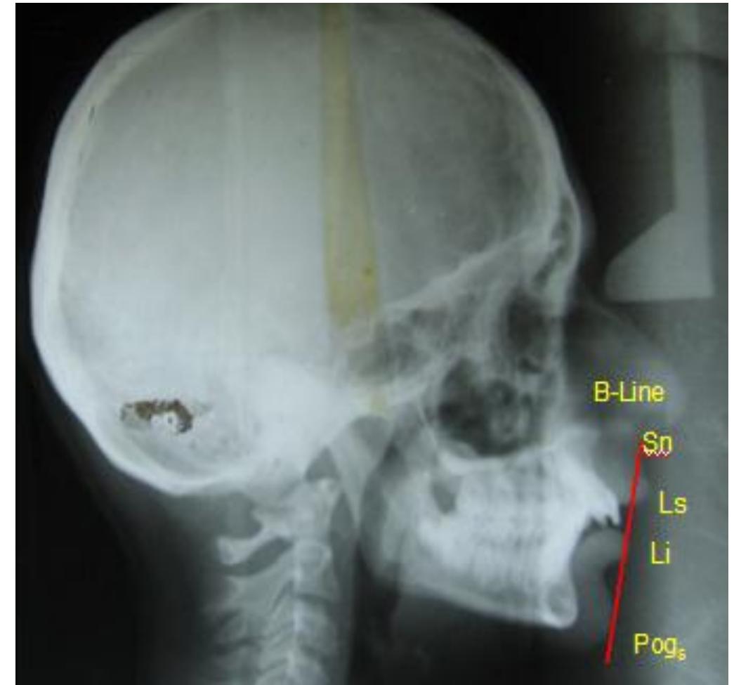‘ig. 4: line joining the soft tissue sub-nasale as the uppe