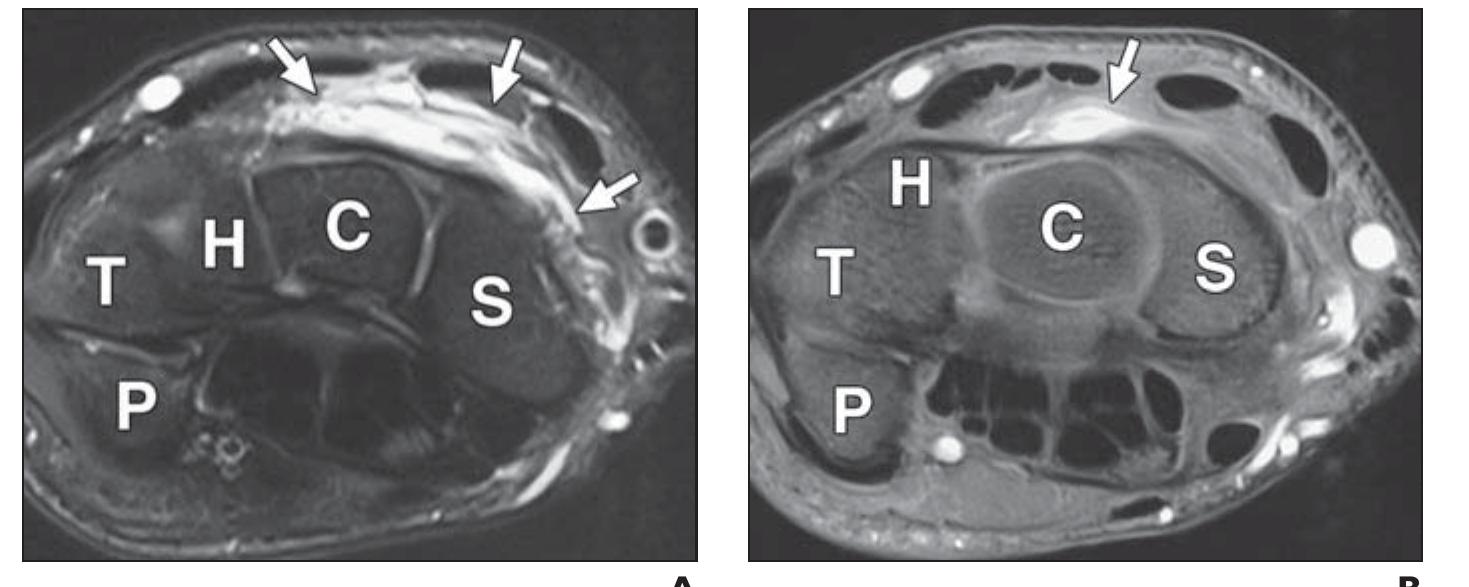 Figure 3 - Imaging of Hand and Wrist Cysts: A Clinical
