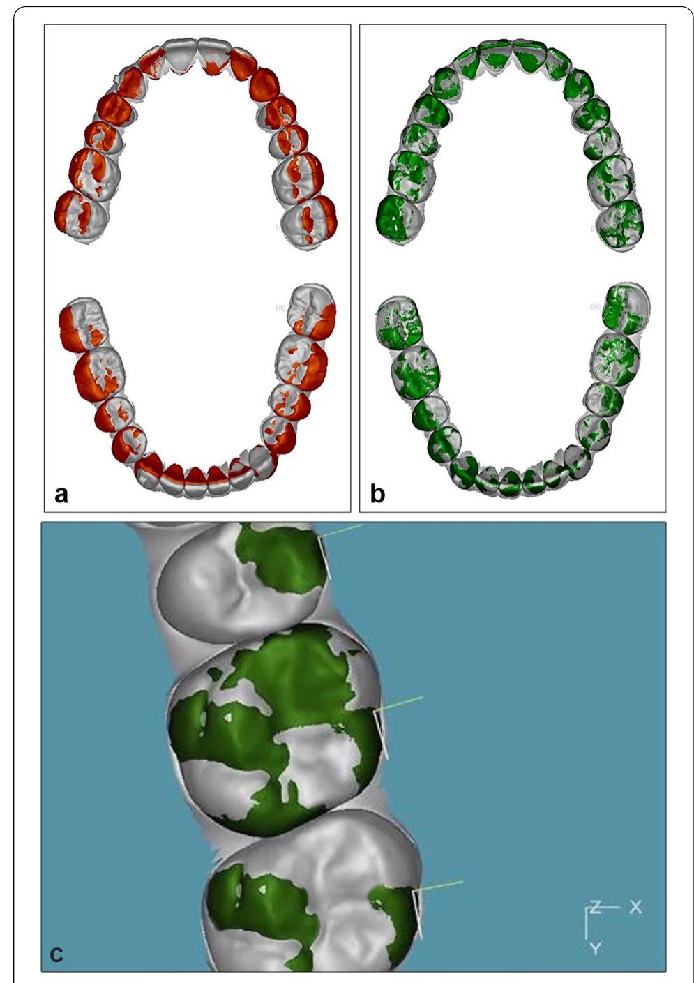 Registration of maxillary models and mandibular models by