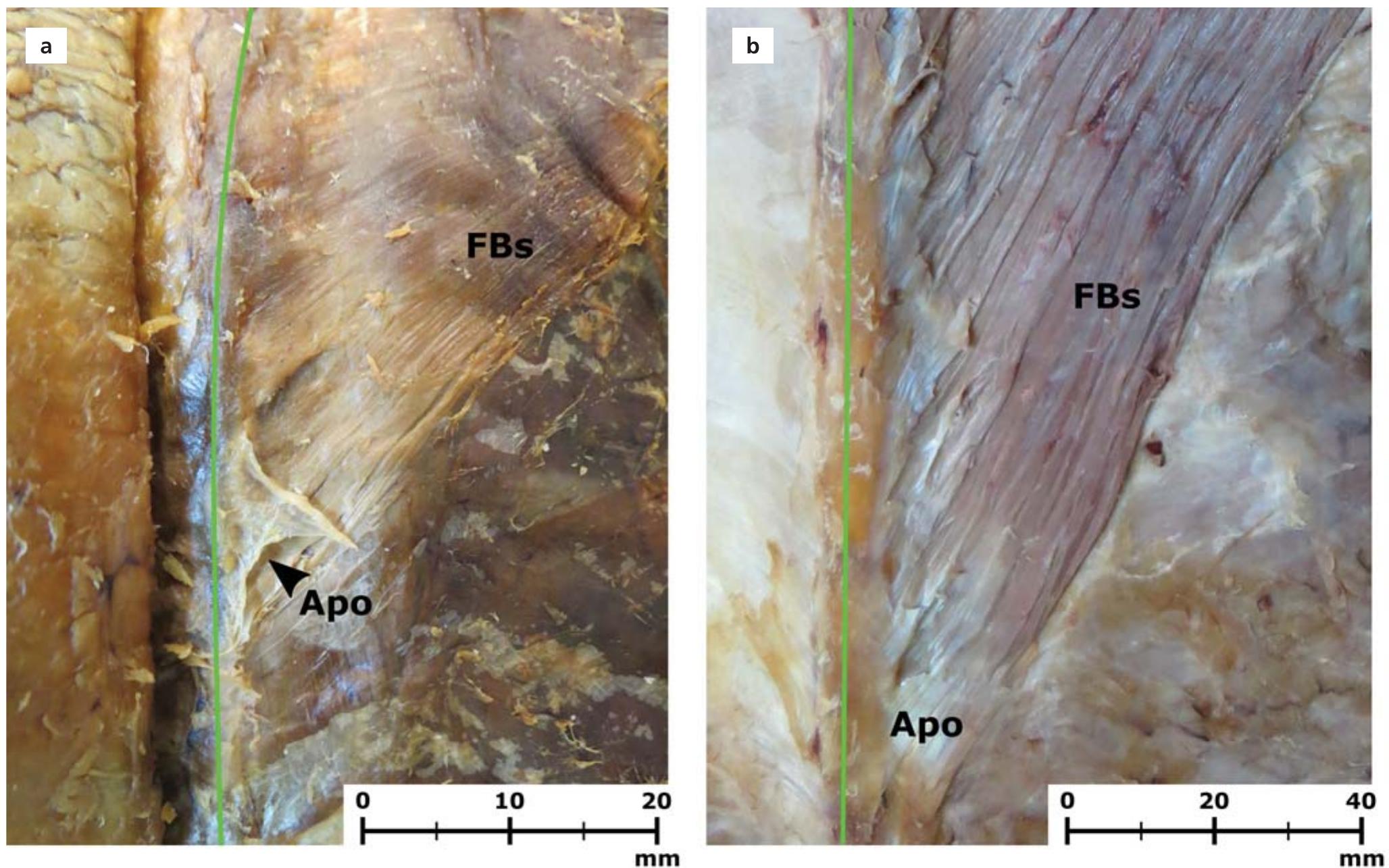 Dissection photographs of fiber bundles in the ascending