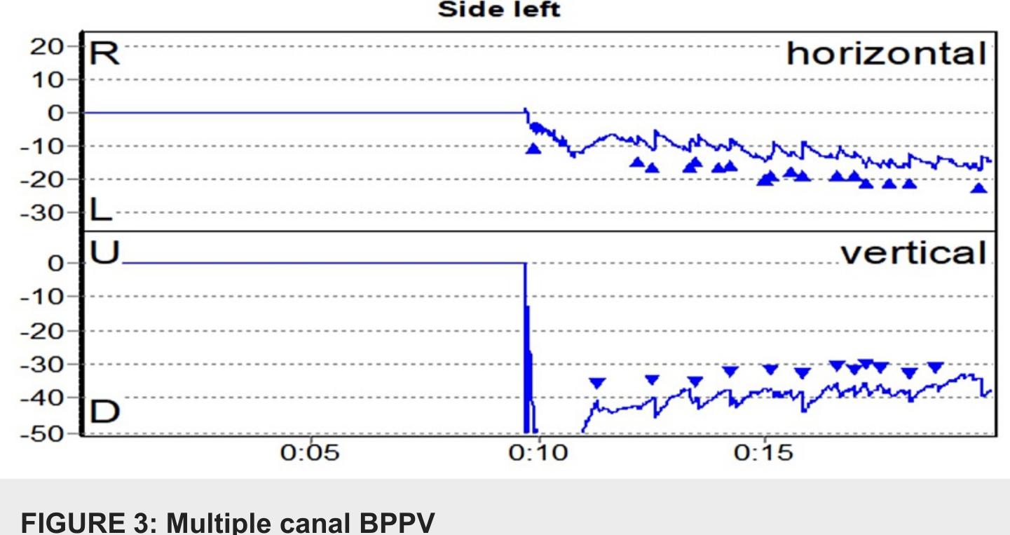 Bppv: benign paroxysmal positional vertigo. followed by