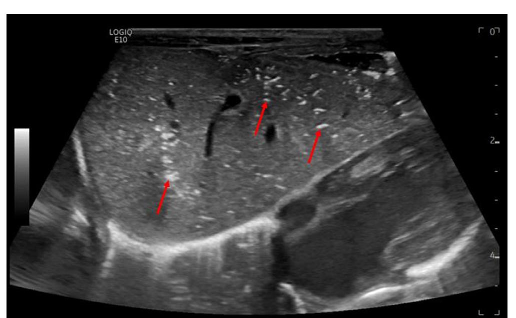 - ultrasound of the liver in the transverse plane showing