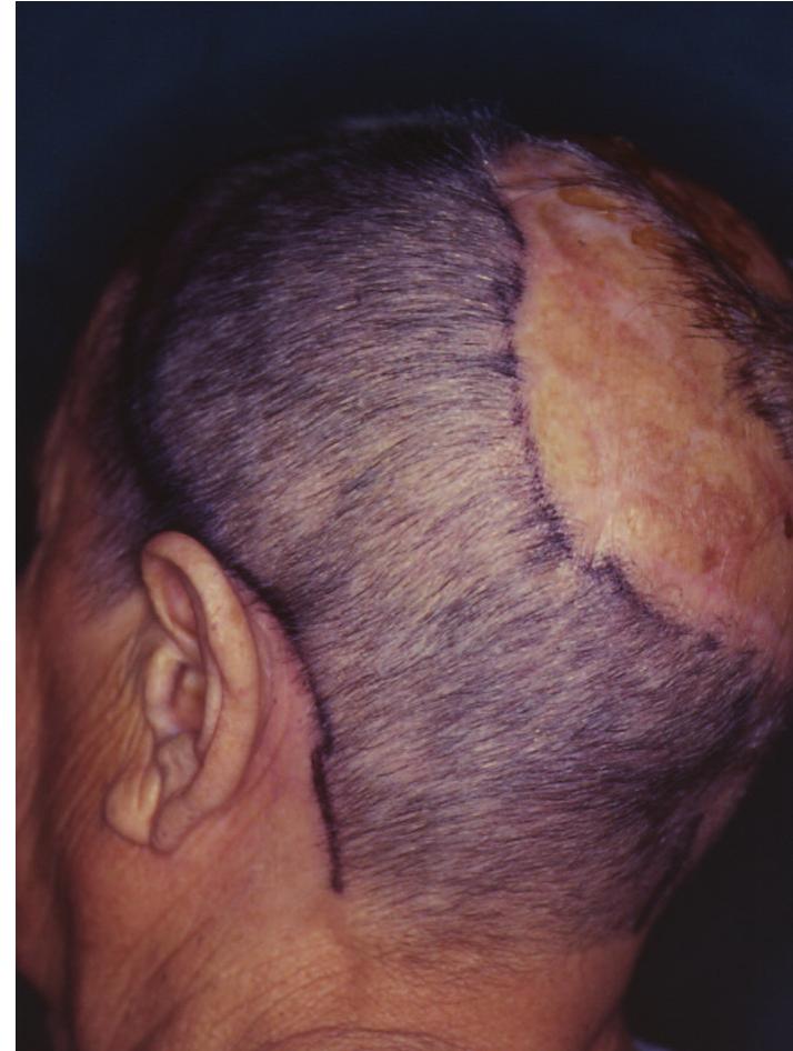 Scalp flap.
