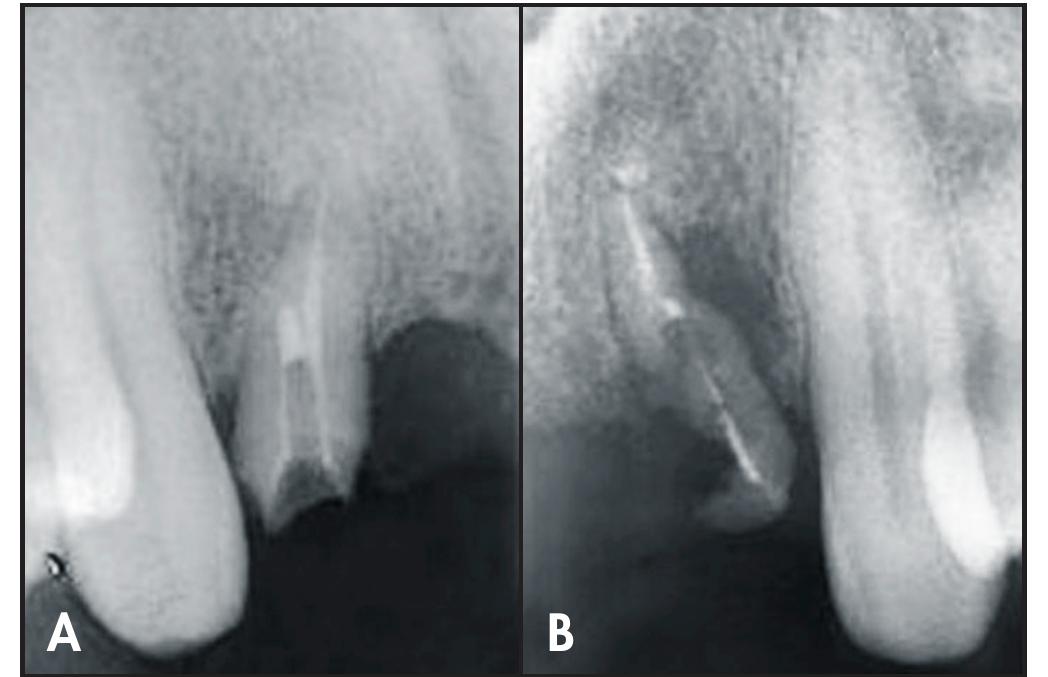 A. radiographic appearance of tooth #7(12) with vertical