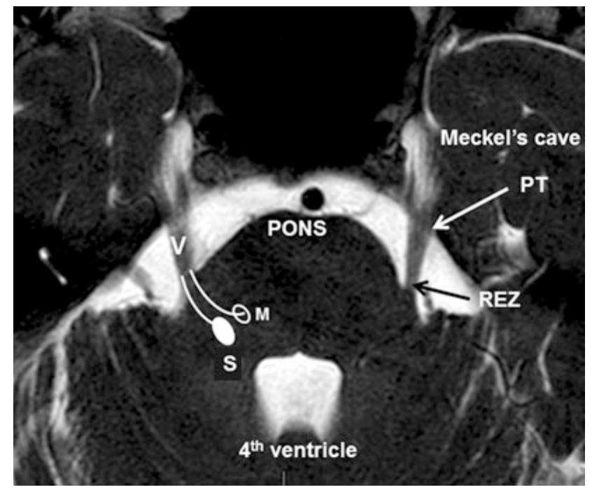 Anatomy of the trigeminal nerve and nuclei within the