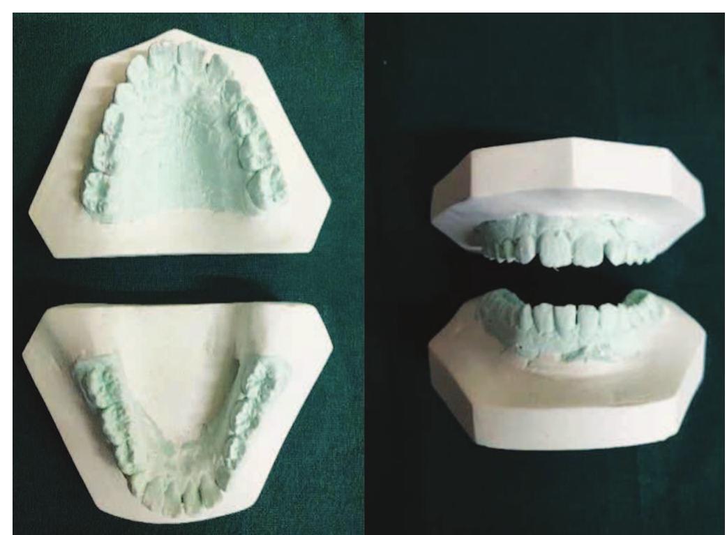 Figure 5 - from Assessment of Dental Crowding Occurring in