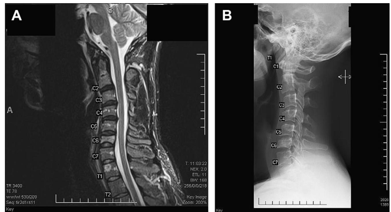 (a) cervical magnetic resonance image, sagittal t2 view.