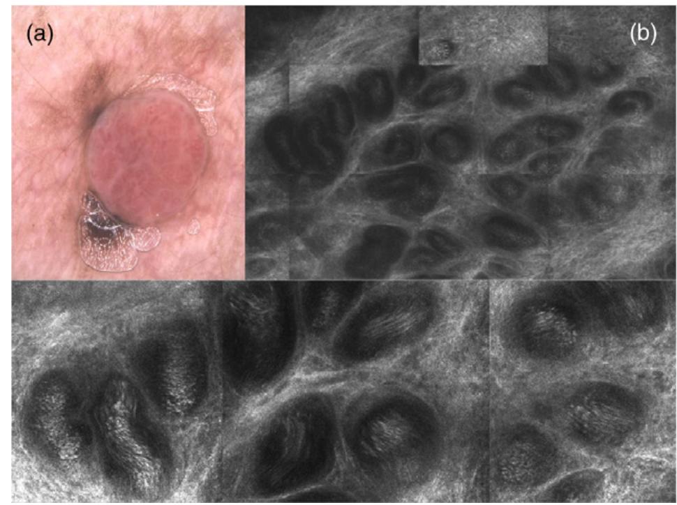 (a) dermoscopical image of an indeterminate red nodule with