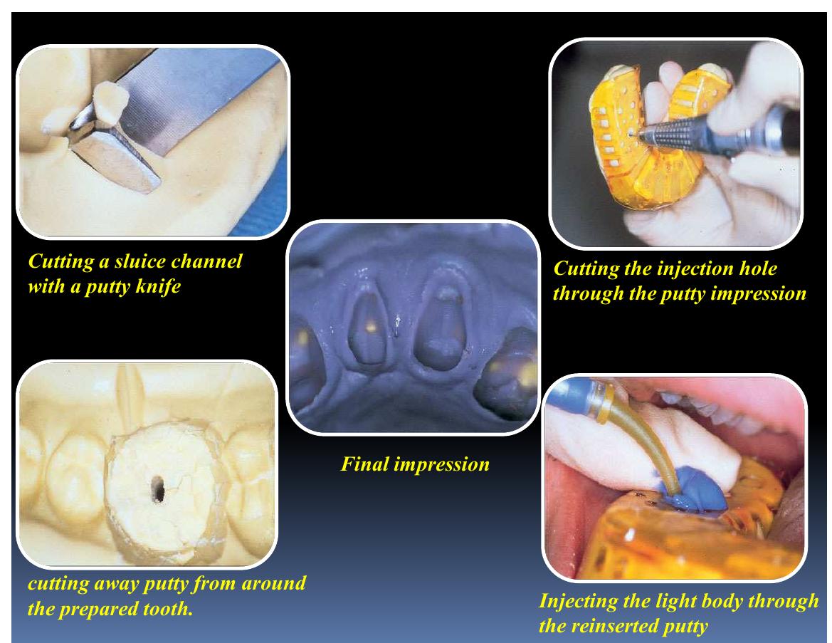 Injection moulded putty wash impression technique