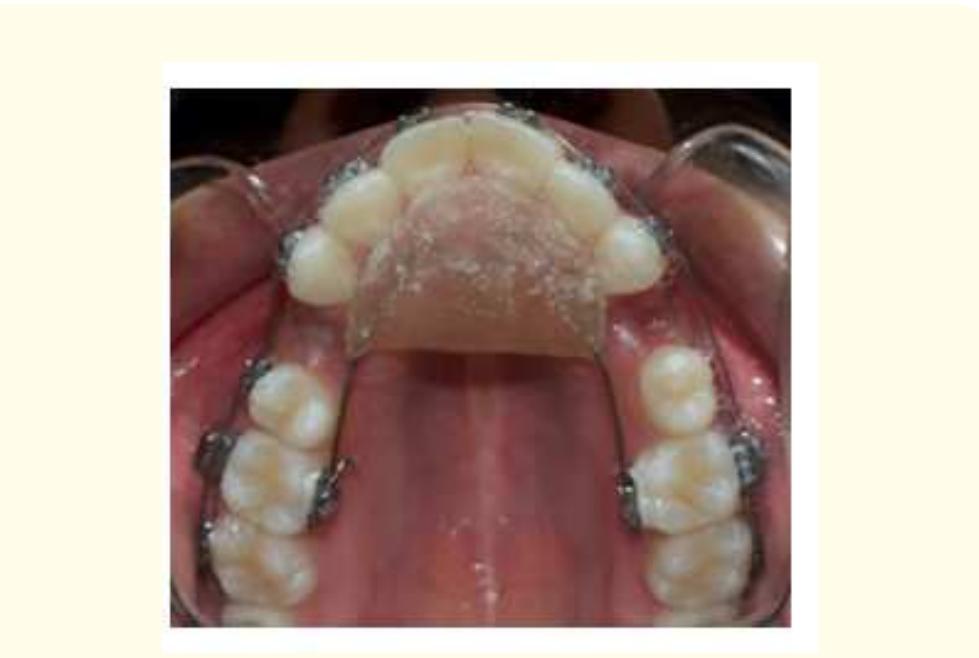 (PDF) The Use of Bite Raisers in Orthodontic Treatment - A Review of ...