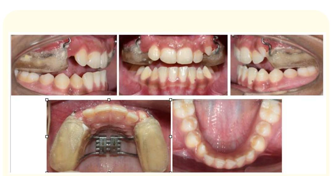(PDF) The Use of Bite Raisers in Orthodontic Treatment - A Review of ...