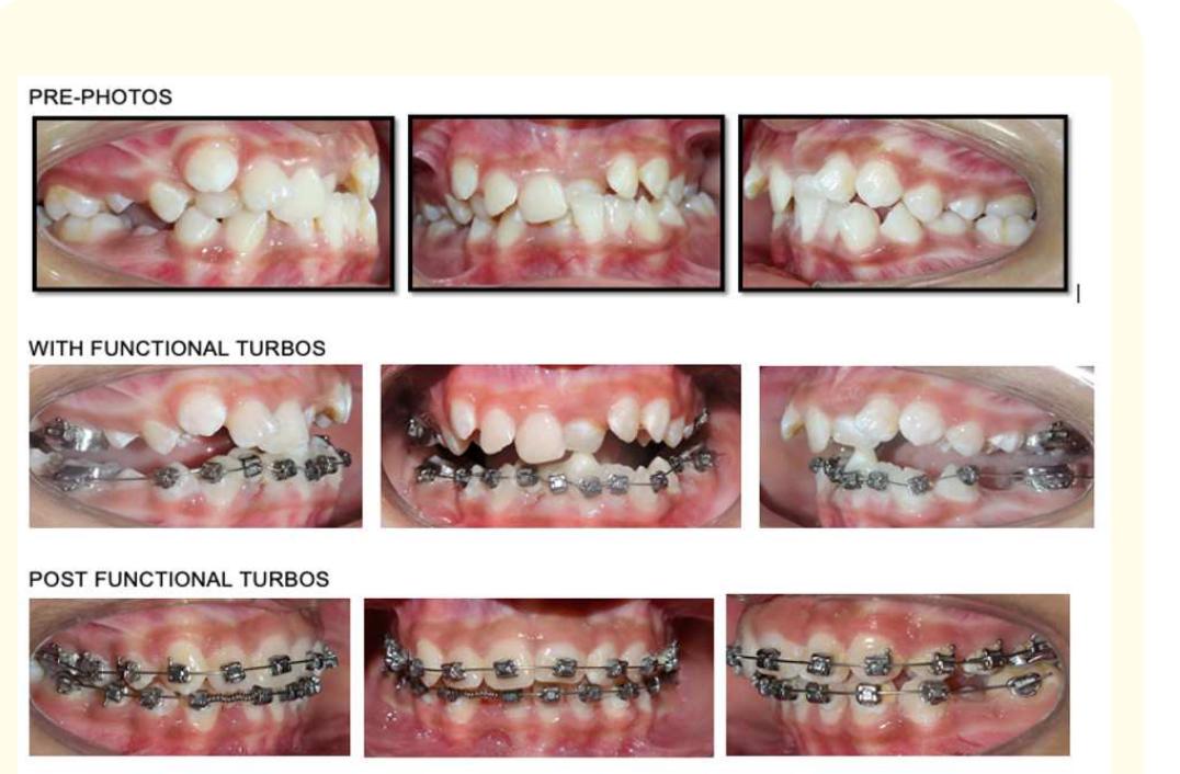 A: functional turbos on mandibular incisors. angular