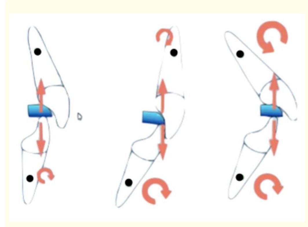 (PDF) The Use of Bite Raisers in Orthodontic Treatment - A Review of ...