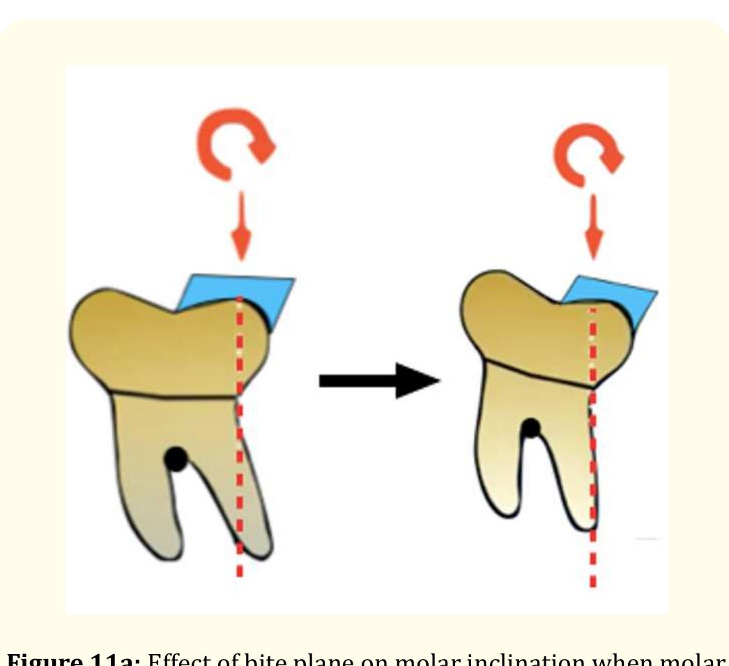 Figure 11 - The Use of Bite Raisers in Orthodontic Treatment