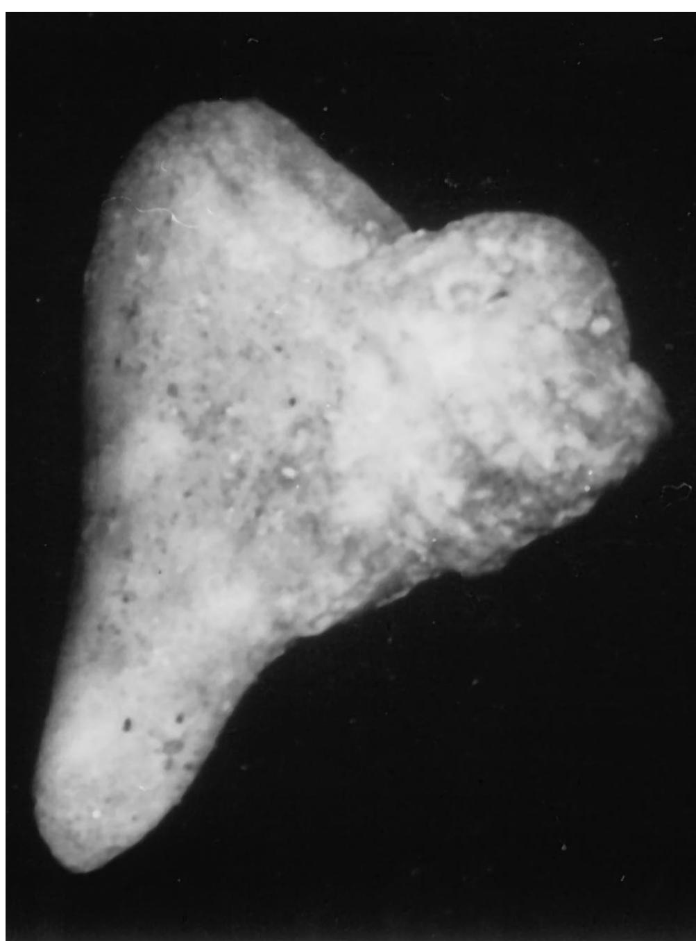 Medial view of a pathological incus from a left ear. the