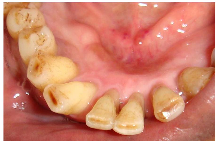 Figure 4 - Surgical removal of mandibular tori and its use