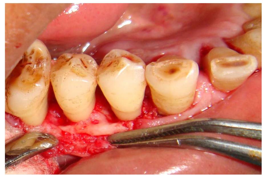 Figure 7 - Surgical removal of mandibular tori and its use
