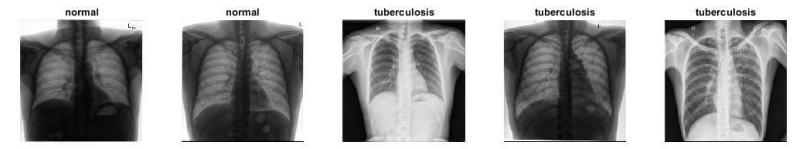 Chest radiograph samples from the shenzhen dataset labeled