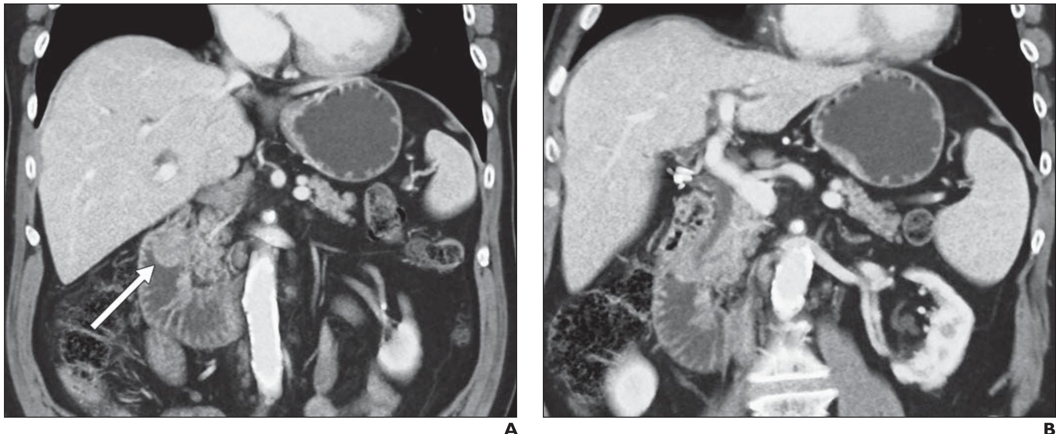 (PDF) Abnormalities of the Distal Common Bile Duct and Ampulla ...