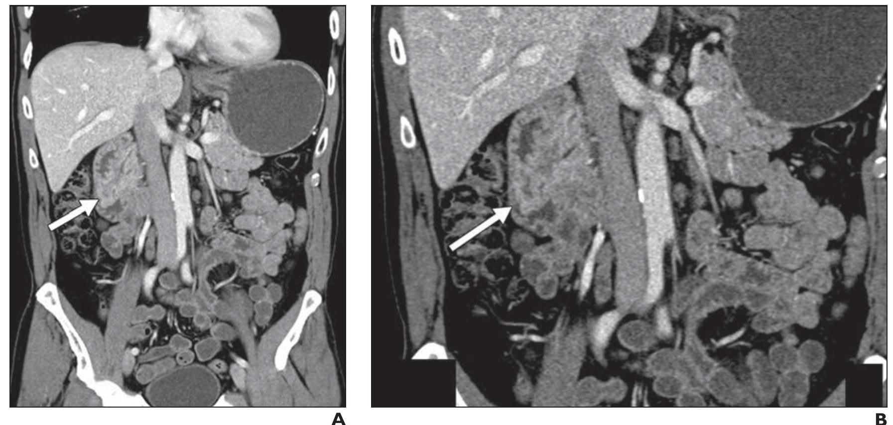 (PDF) Abnormalities of the Distal Common Bile Duct and Ampulla ...