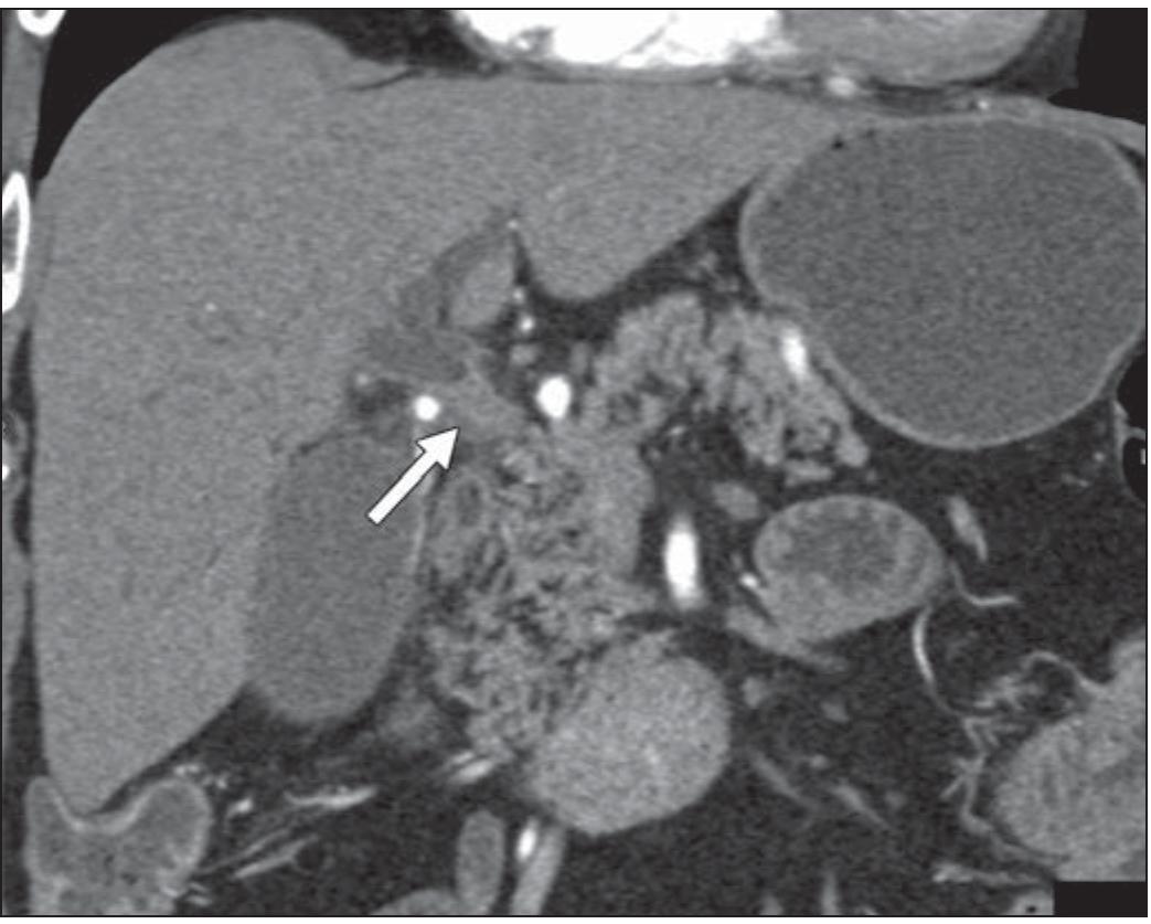 (PDF) Abnormalities of the Distal Common Bile Duct and Ampulla ...