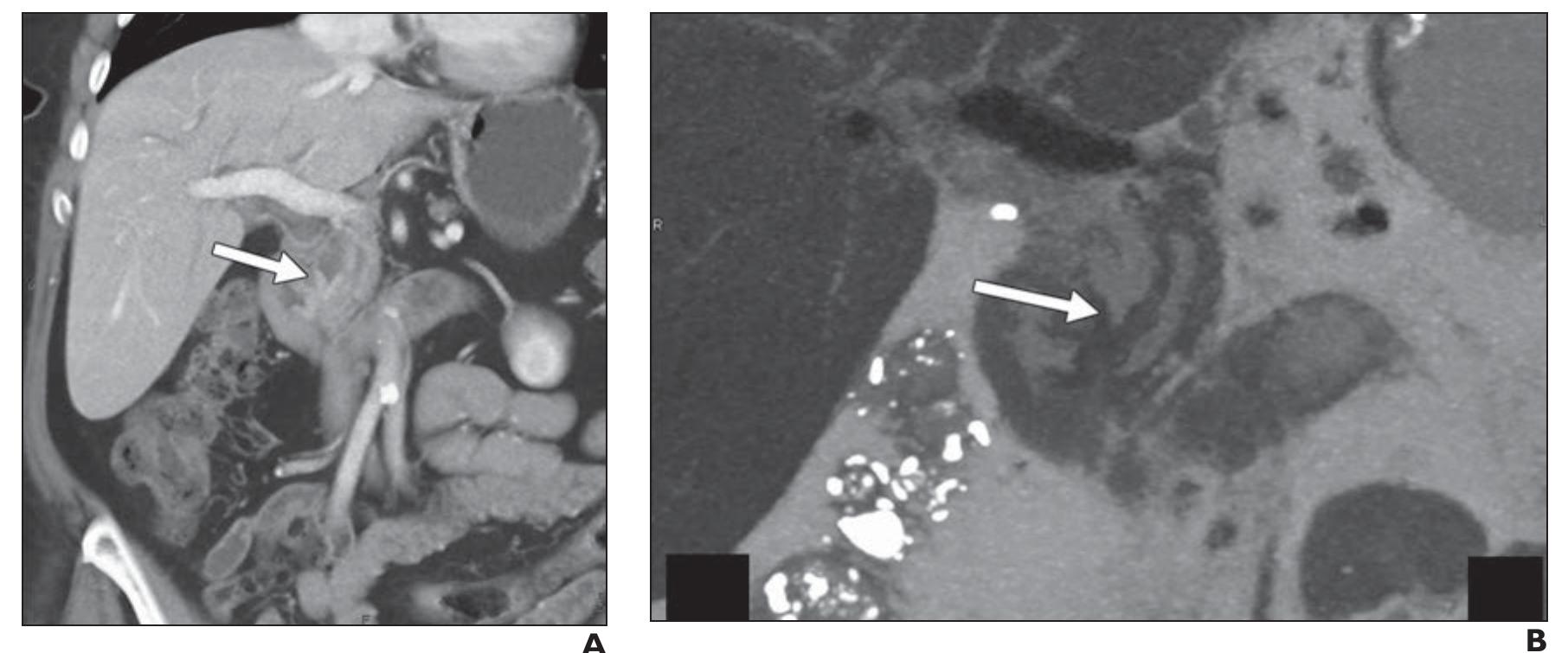 Figure 4 - Abnormalities of the Distal Common Bile Duct and