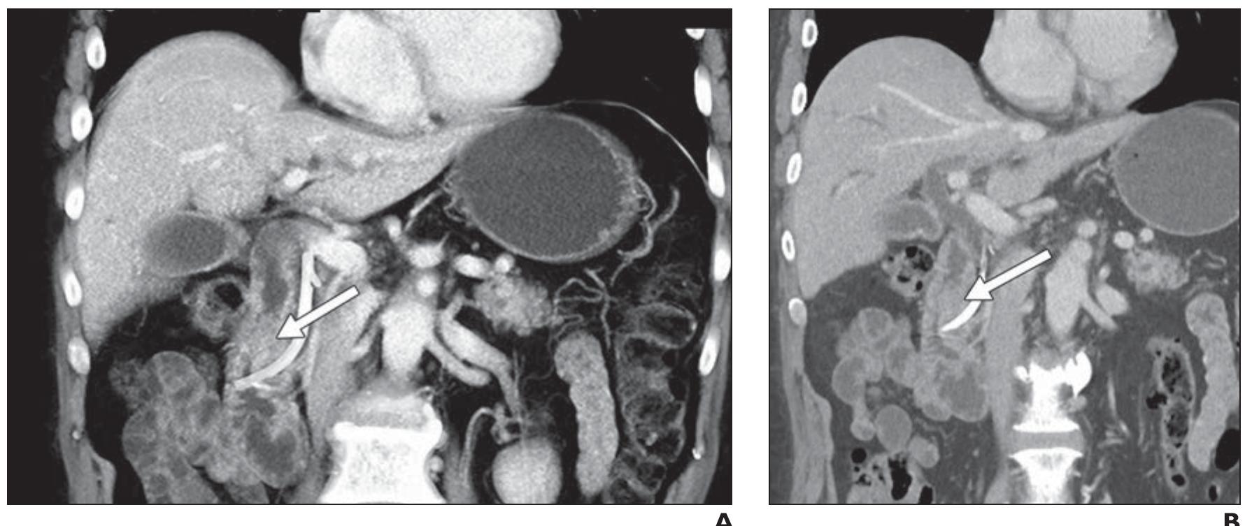 (PDF) Abnormalities of the Distal Common Bile Duct and Ampulla ...