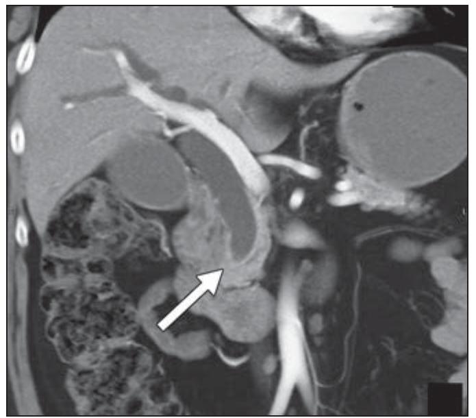(PDF) Abnormalities of the Distal Common Bile Duct and Ampulla ...