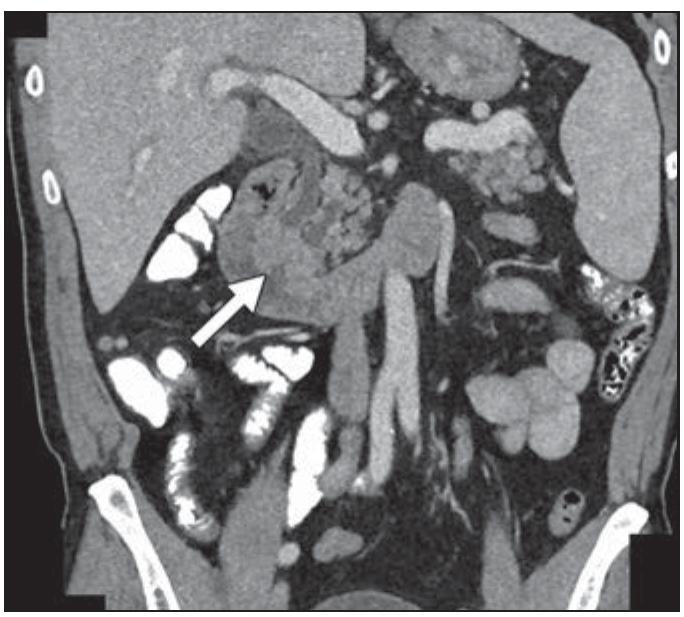 Figure 8 - Abnormalities of the Distal Common Bile Duct and