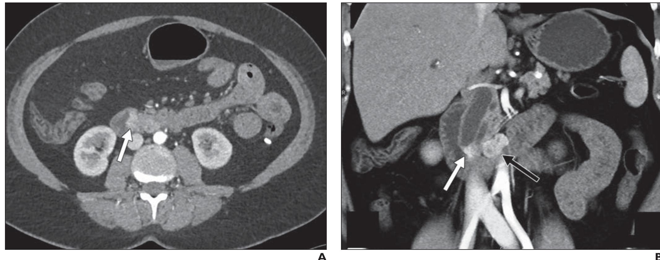 (PDF) Abnormalities of the Distal Common Bile Duct and Ampulla ...