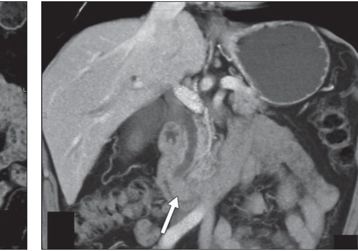 Figure 11 - Abnormalities of the Distal Common Bile Duct and