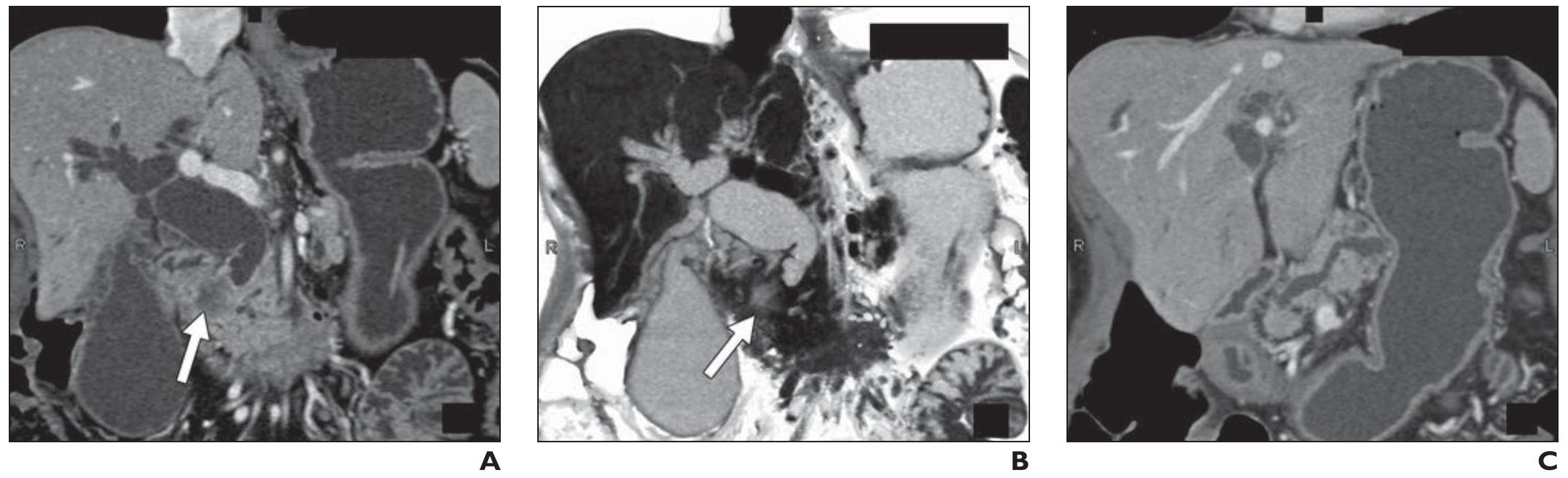 (PDF) Abnormalities of the Distal Common Bile Duct and Ampulla ...