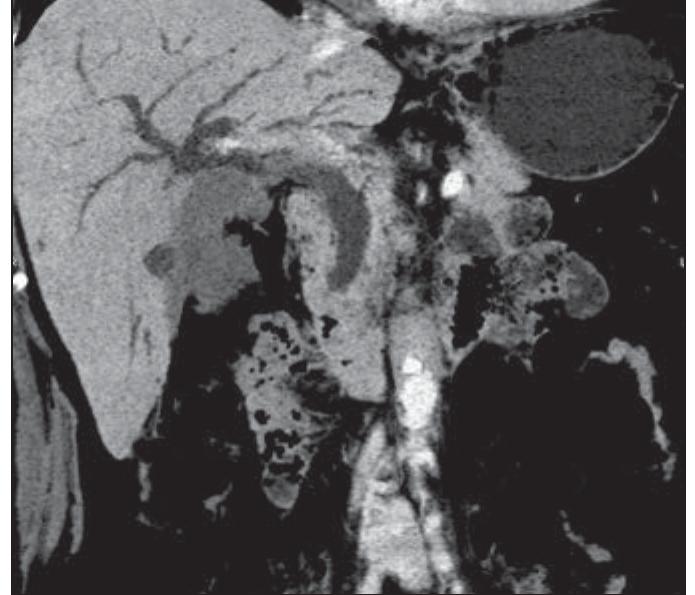 (PDF) Abnormalities of the Distal Common Bile Duct and Ampulla ...