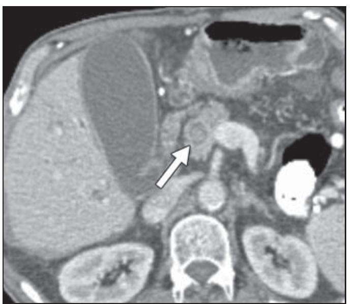 (PDF) Abnormalities of the Distal Common Bile Duct and Ampulla ...