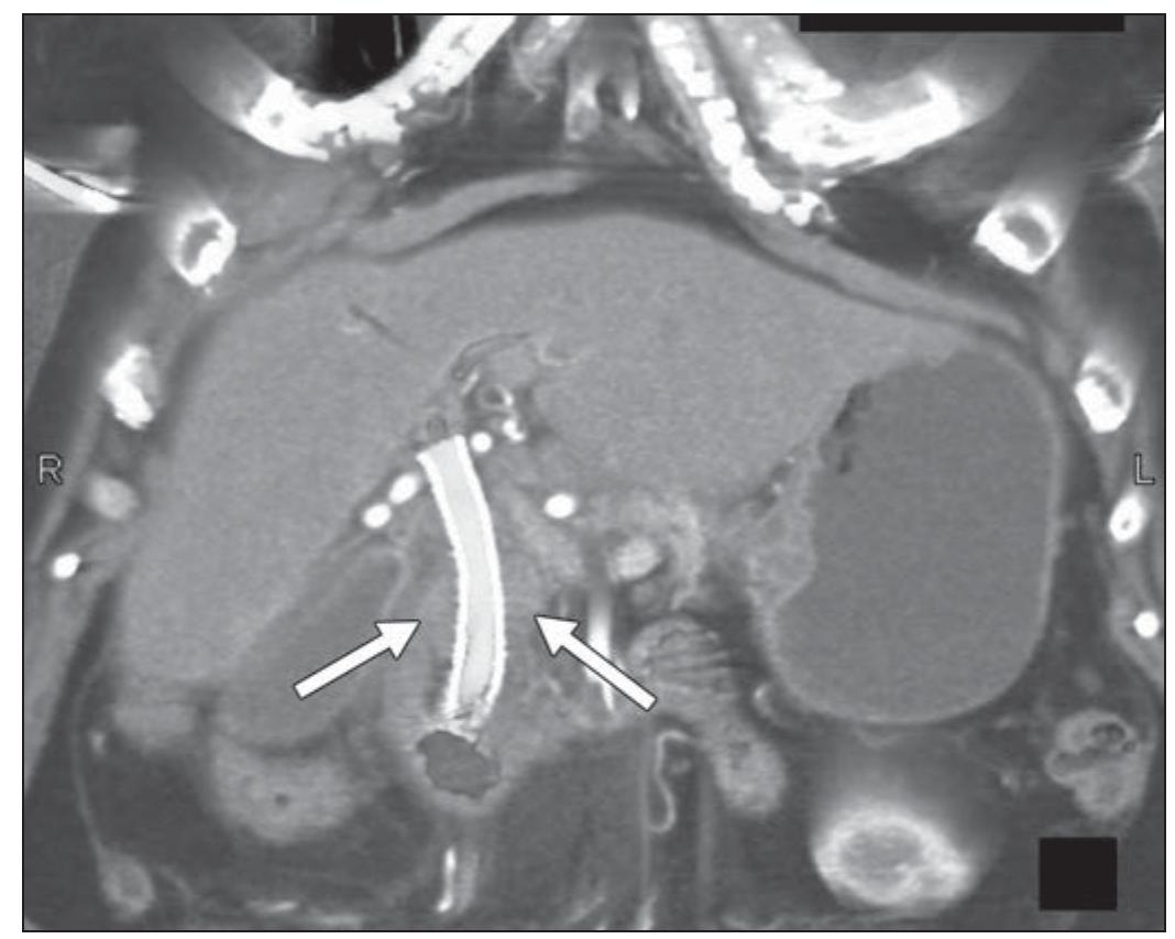 (PDF) Abnormalities of the Distal Common Bile Duct and Ampulla ...